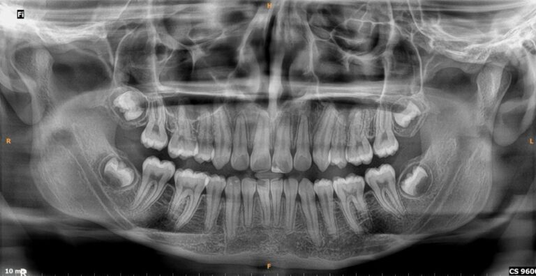 Dental Occlusion and TMJ: The Interrelationship – Fundamental Concepts ...