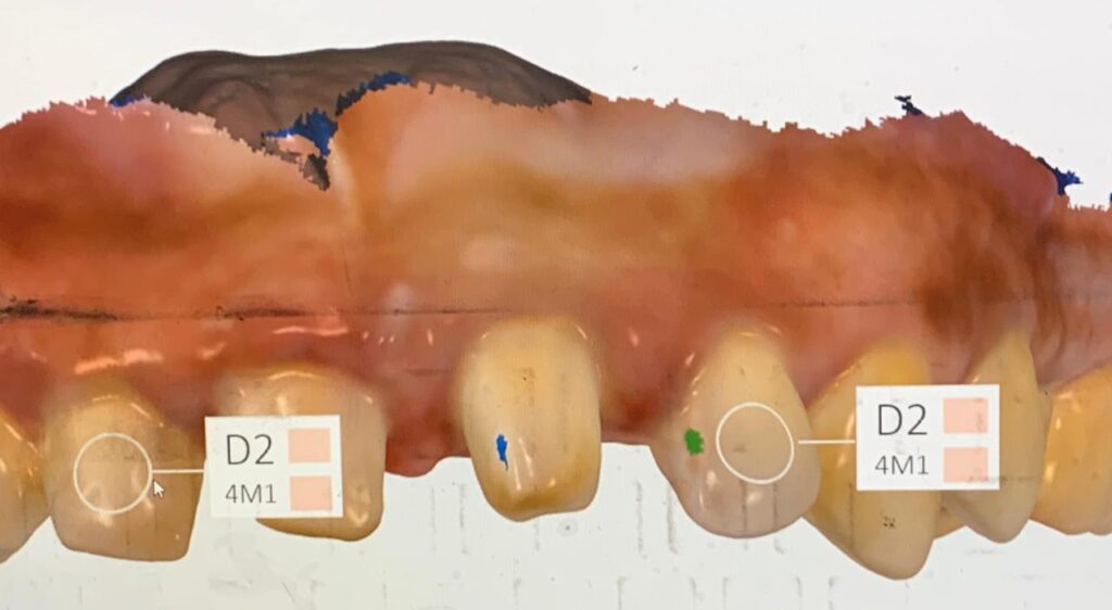Understanding Crown Margins: A Deep Dive into Design, Materials, and ...