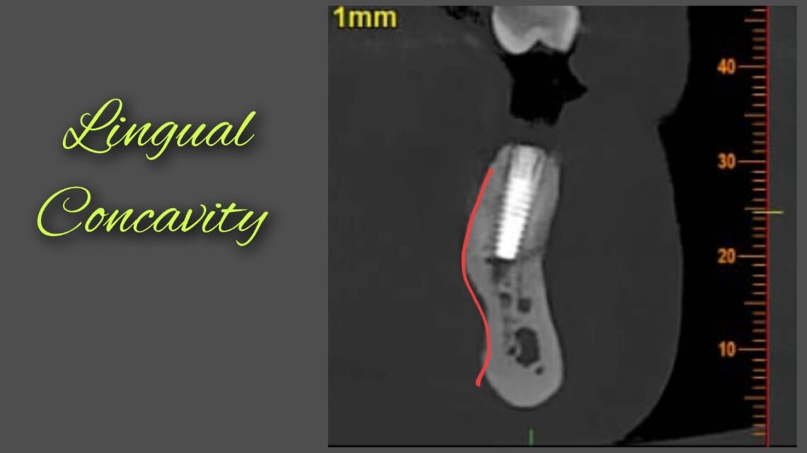 Dental Implantology Tip 3: Mandibular Lingual Concavity – A Hidden Risk ...